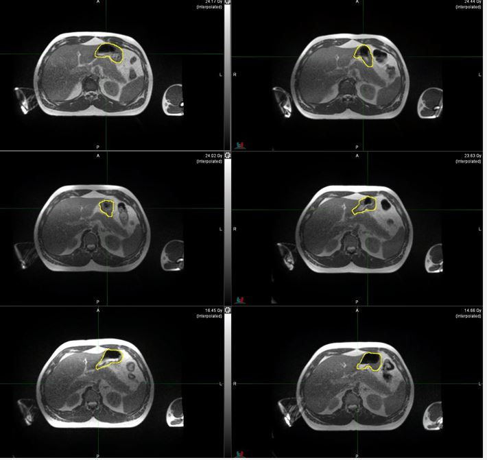 Gastric MALT Lymphoma | GenesisCare UK