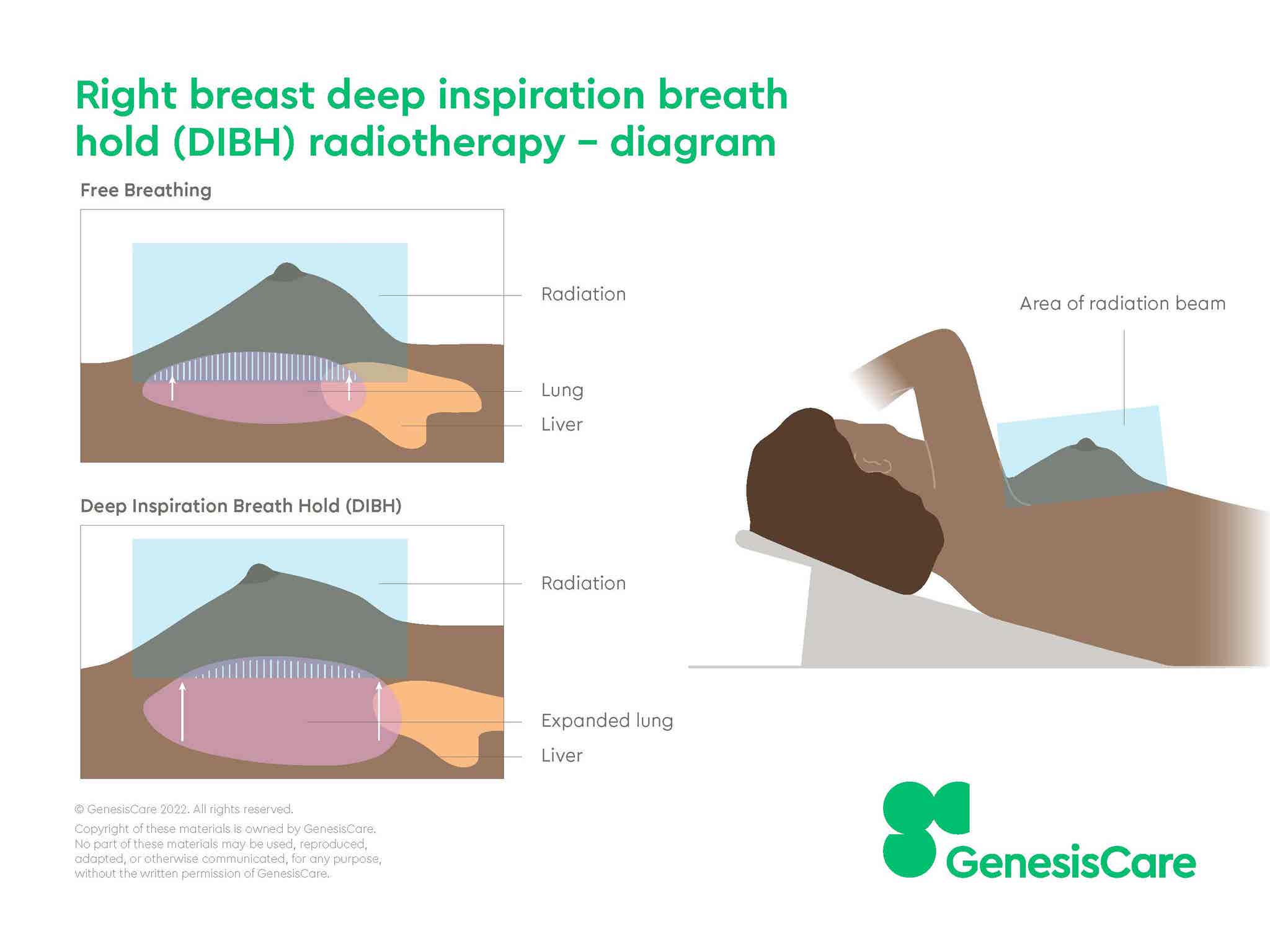 Putting the patient first: new ways to treat breast cancer | GenesisCare UK