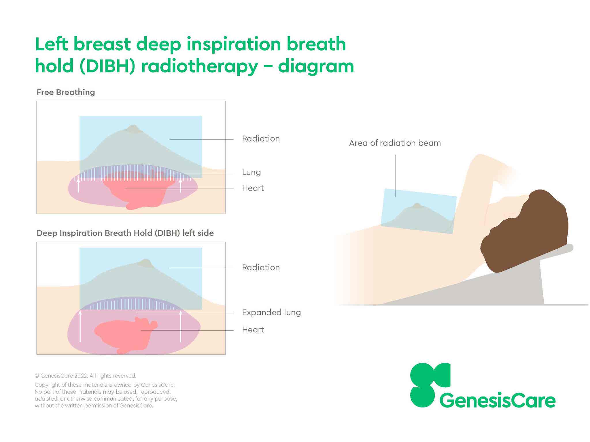 Putting the patient first: new ways to treat breast cancer | GenesisCare UK