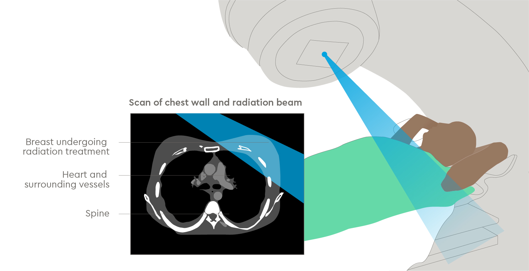 Breast illustrations | GenesisCare UK